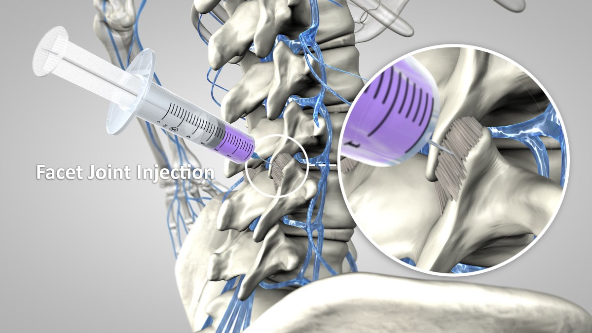 Facet Joint Injection – marcel schneider grafik
