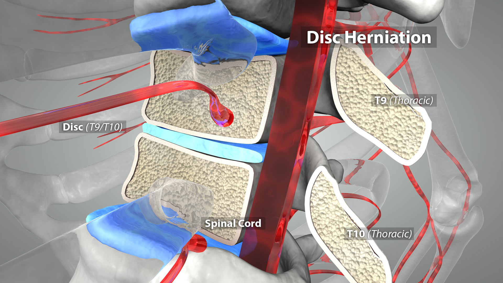 Disc Herniation – marcel schneider grafik